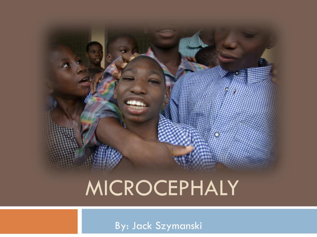 PPT - MICROCEPHALY PowerPoint Presentation, free download - ID:3780061