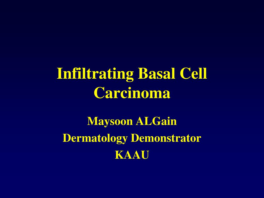 PPT - Infiltrating Basal Cell Carcinoma PowerPoint Presentation, free ...