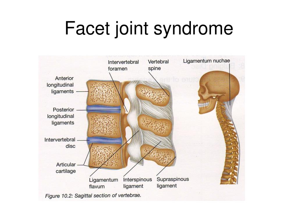 PPT - Facet joint syndrome PowerPoint Presentation, free download - ID ...