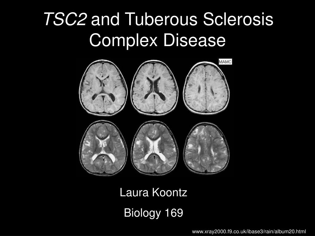 PPT - TSC2 and Tuberous Sclerosis Complex Disease PowerPoint ...