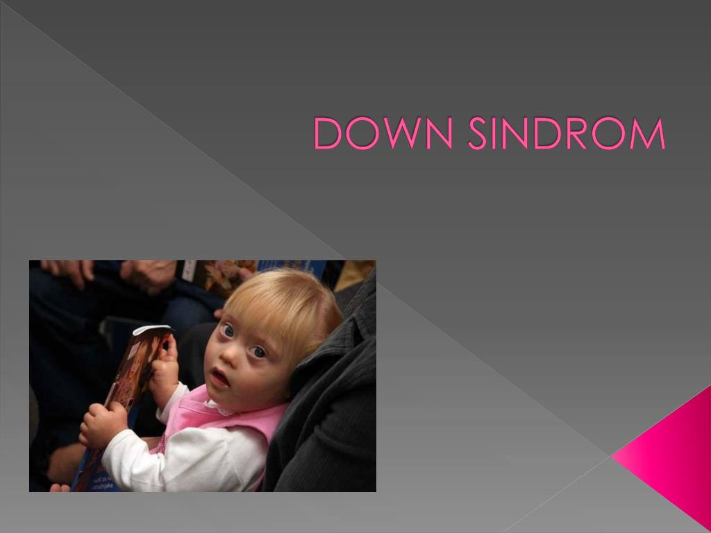 PPT - DOWN SINDROM PowerPoint Presentation, free download - ID:3913098