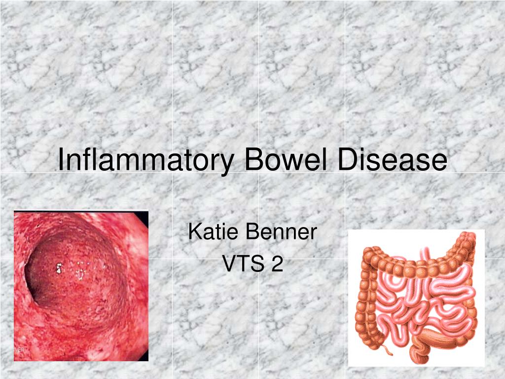 PPT - Inflammatory Bowel Disease PowerPoint Presentation, free download ...