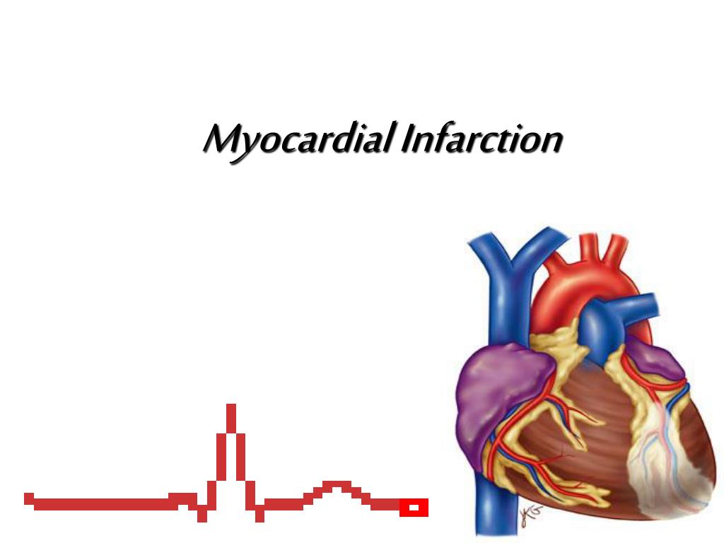 PPT - Myocardial Infarction PowerPoint Presentation, free download - ID ...