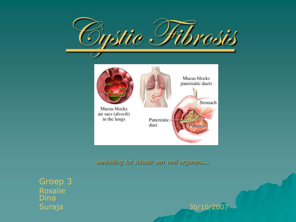 PPT - Cystic Fibrosis PowerPoint Presentation, free download - ID:4072639