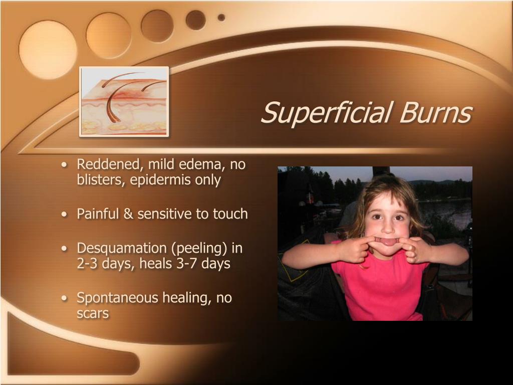 PPT - Superficial Burns PowerPoint Presentation, free download - ID:4124225