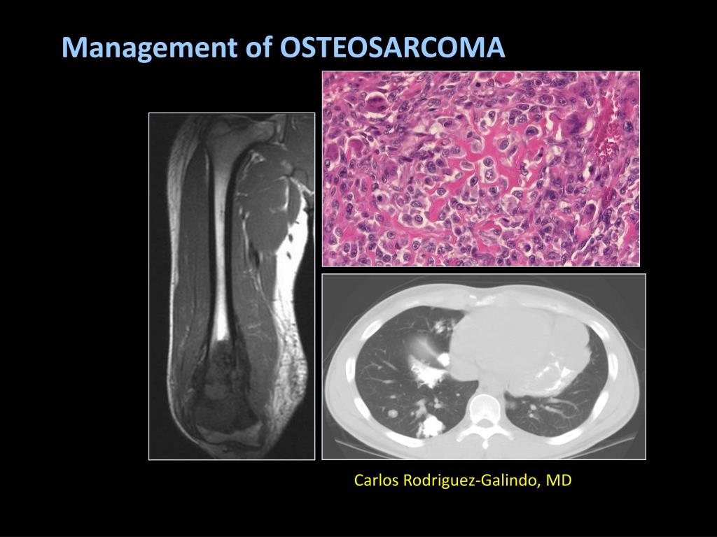 PPT - Management of OSTEOSARCOMA PowerPoint Presentation, free download ...