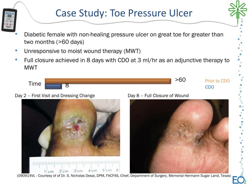 PPT - Case Study: Toe Pressure Ulcer PowerPoint Presentation, free ...