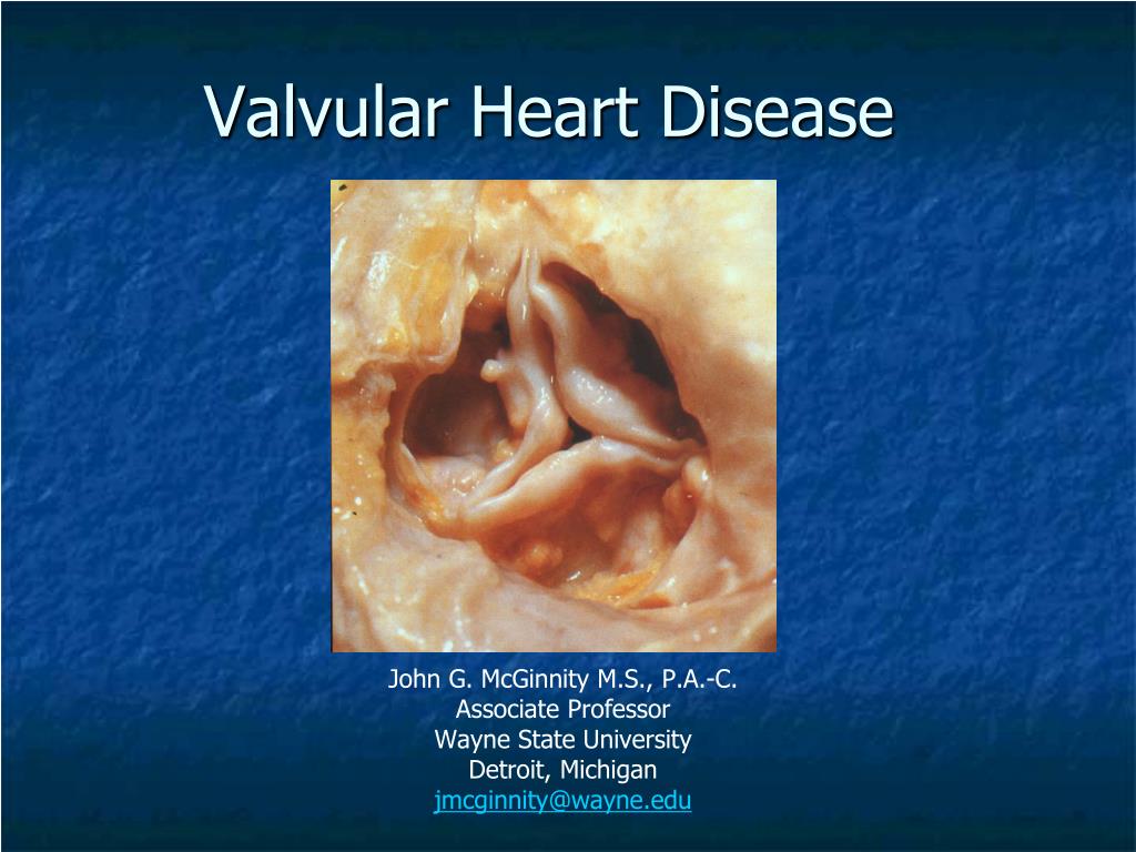 PPT - Valvular Heart Disease PowerPoint Presentation, free download ...