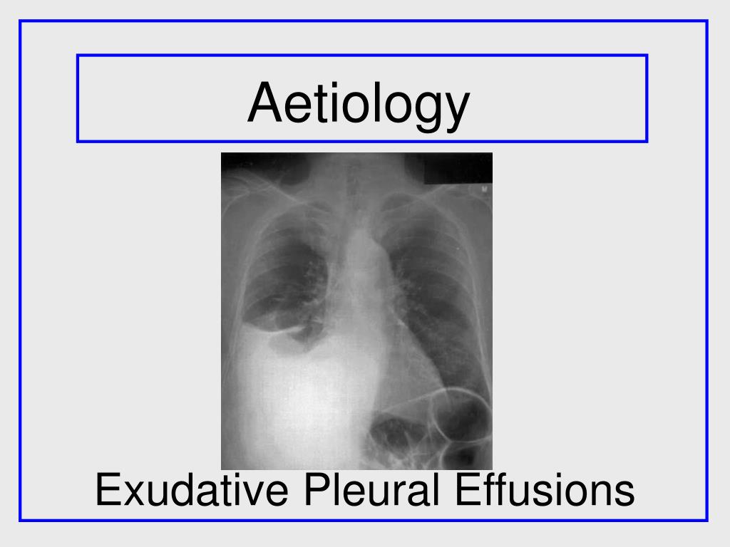 PPT - Exudative Pleural Effusions PowerPoint Presentation, free ...
