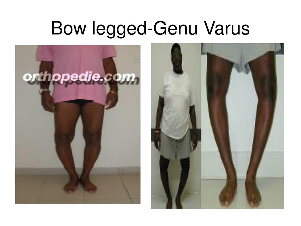 PPT - Bow legged-Genu Varus PowerPoint Presentation, free download - ID ...