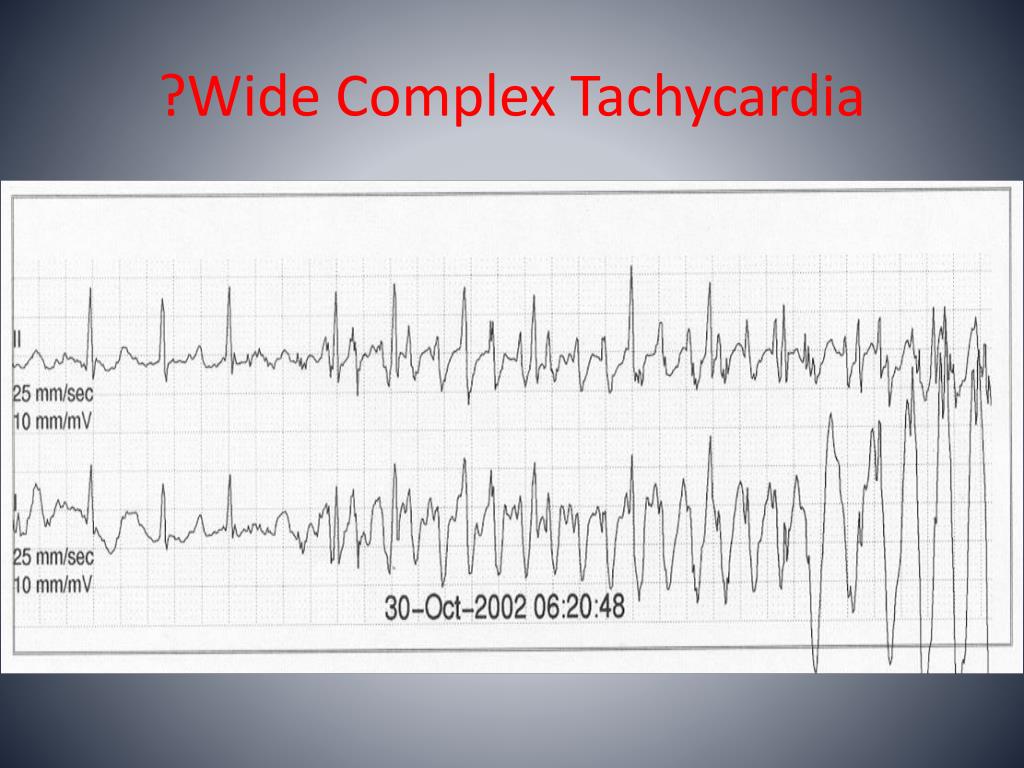 PPT - ?Wide Complex Tachycardia PowerPoint Presentation, free download ...