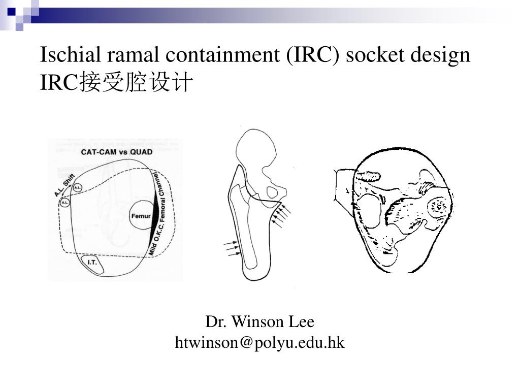 PPT - Ischial ramal containment (IRC) socket design IRC 接受腔设计 PowerPoint Presentation - ID:4632552