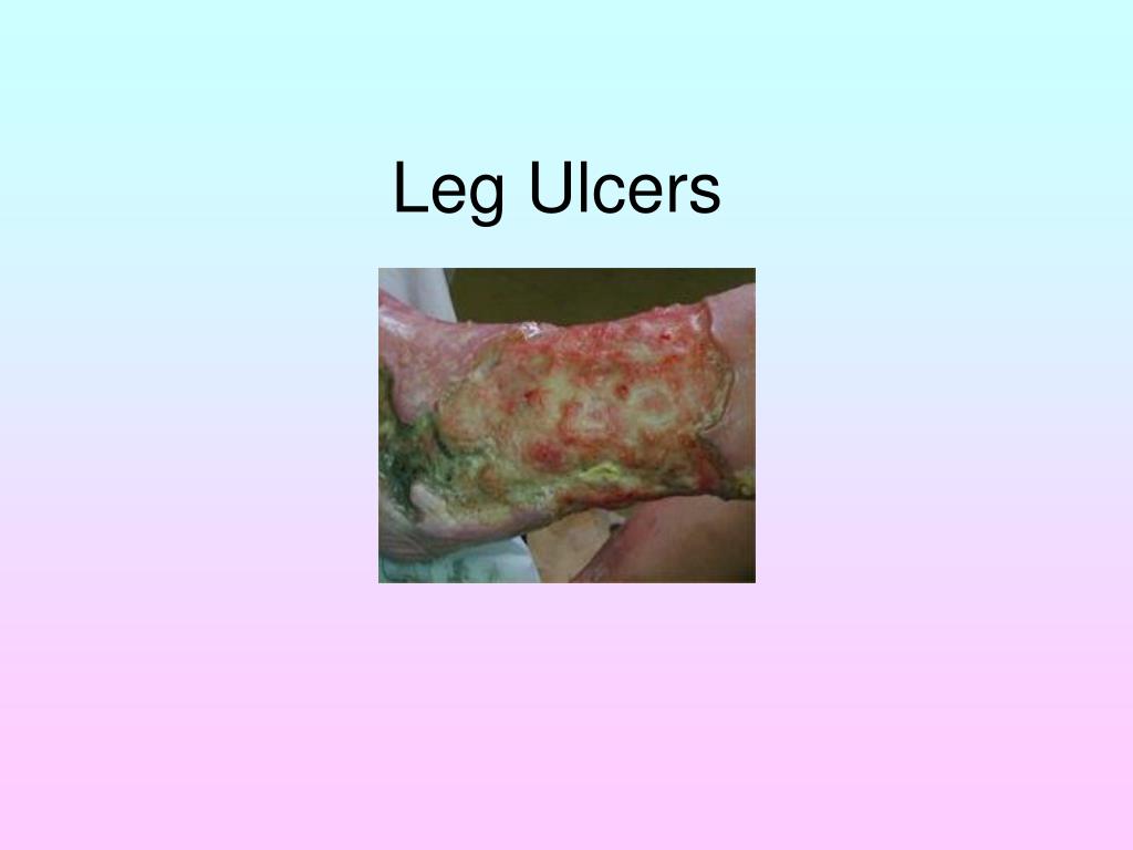 PPT - Leg Ulcers PowerPoint Presentation, free download - ID:4699749