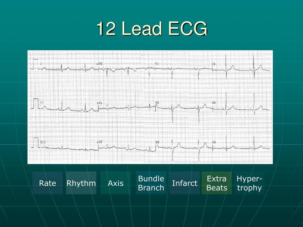 PPT - 12 Lead ECG PowerPoint Presentation, free download - ID:4846612
