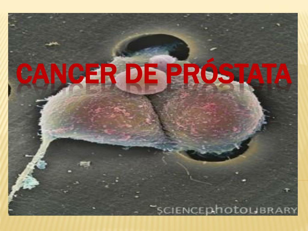 PPT - cancer de próstata PowerPoint Presentation, free download - ID ...
