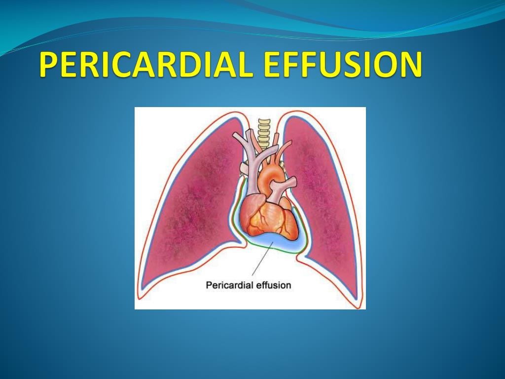 PPT - PERICARDIAL EFFUSION PowerPoint Presentation, free download - ID ...