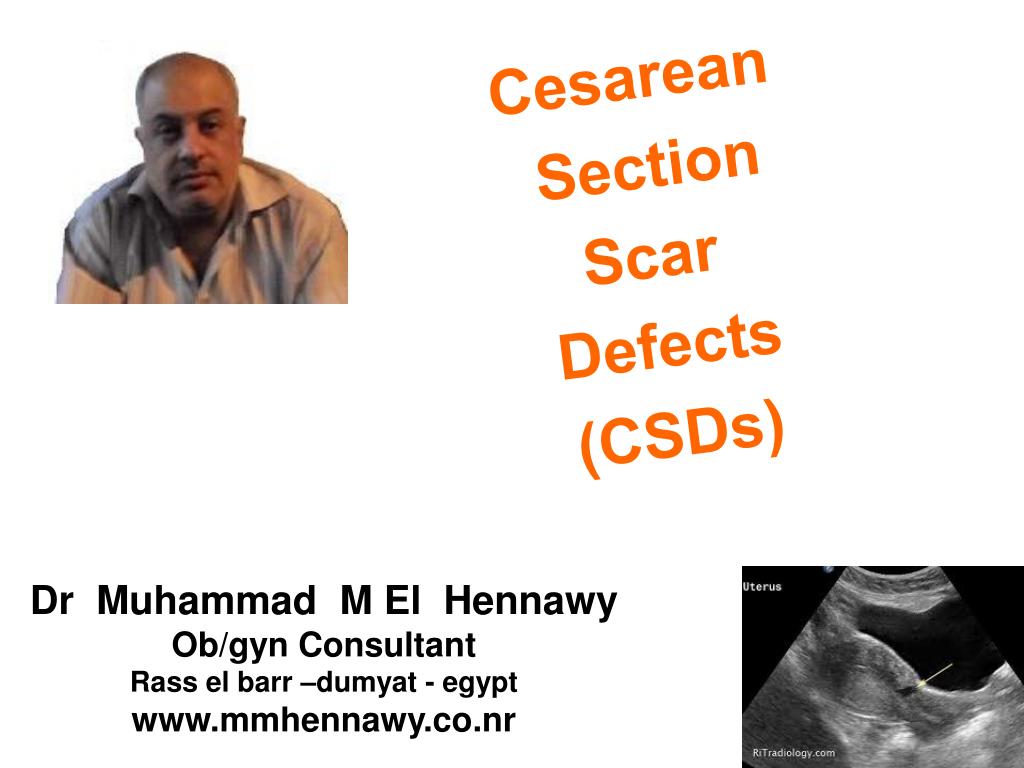 PPT - Cesarean Section Scar Defects (CSDs) PowerPoint Presentation ...