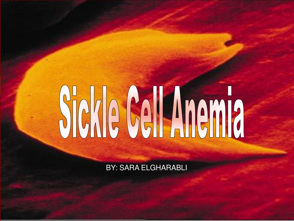 PPT - Sickle Cell Anemia PowerPoint Presentation, free download - ID ...