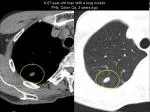 PPT - Chest Radiology Plain Film and CT- Beyond the Basics PowerPoint ...