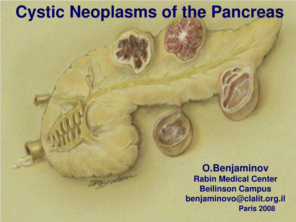 PPT - Cystic Neoplasms of the Pancreas PowerPoint Presentation, free ...