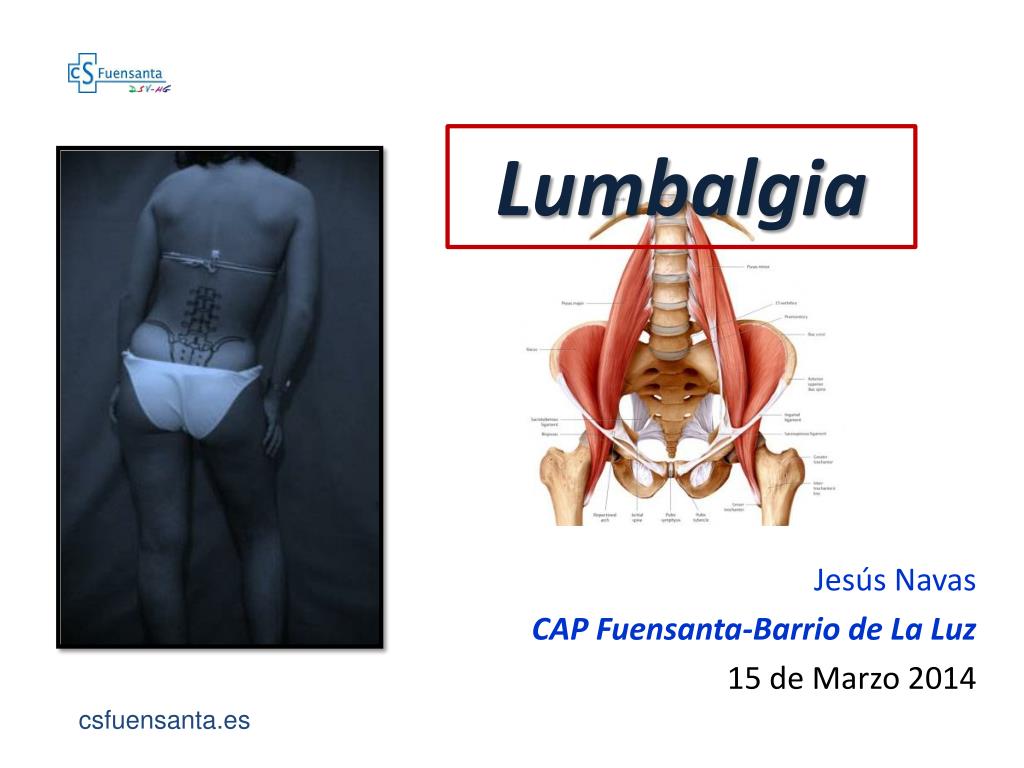 PPT - Lumbalgia PowerPoint Presentation, free download - ID:5056709